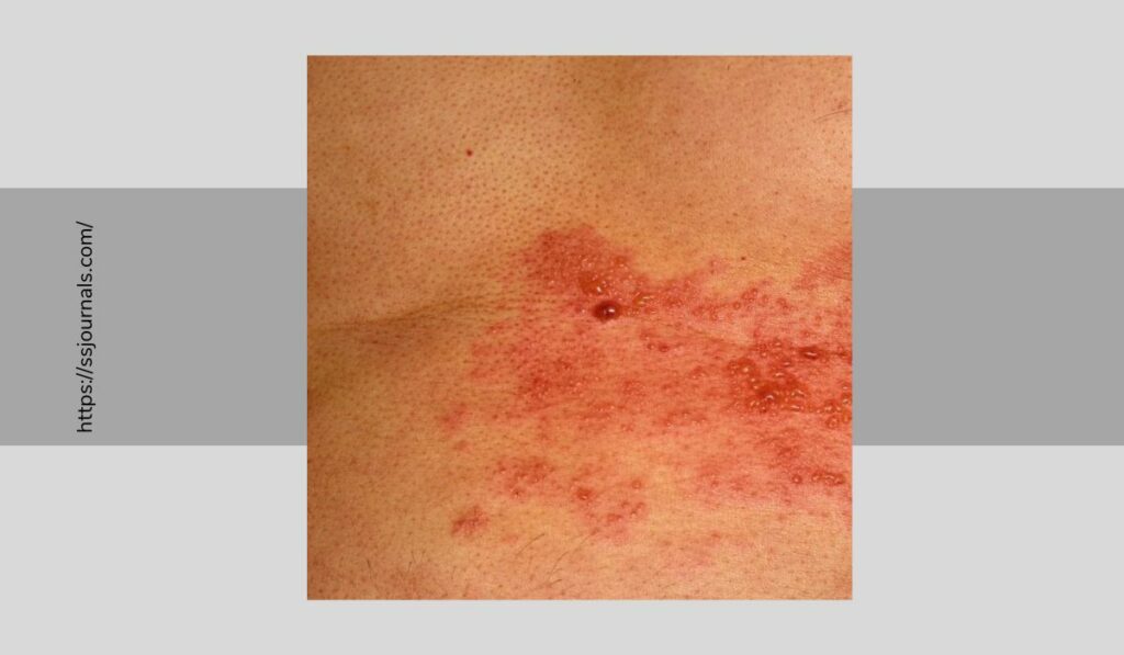 Rash Under Your Breasts - What's Causes Irritated Breast Skin?